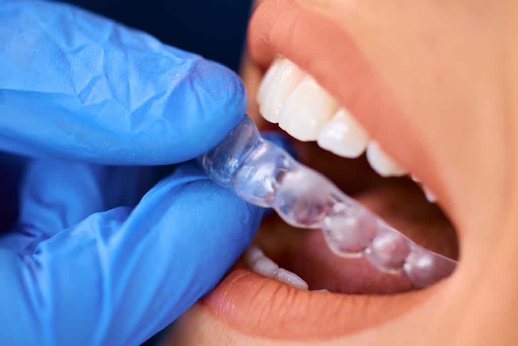 Discovering the Benefits of Invisalign Kent: Your Path to a Perfect Smile